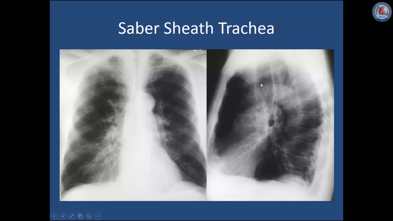 Imaging of the trachea - YouTube