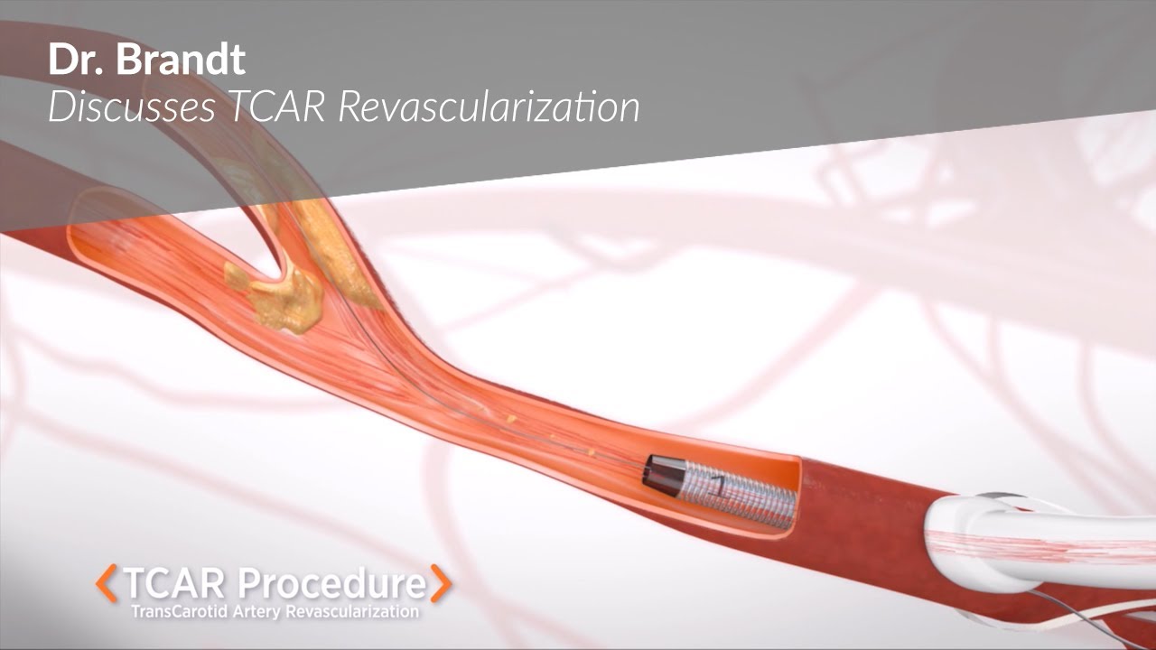 Dr. Brandt discusses TCAR Revascularization - YouTube