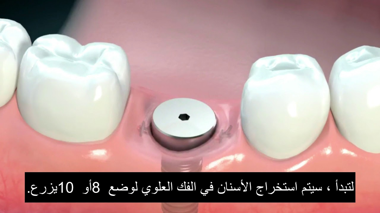 5 Simple Steps for Immediate Implant - YouTube
