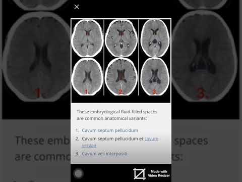 Case 038 cavum septum pellucidum , vergae and interpositum - YouTube