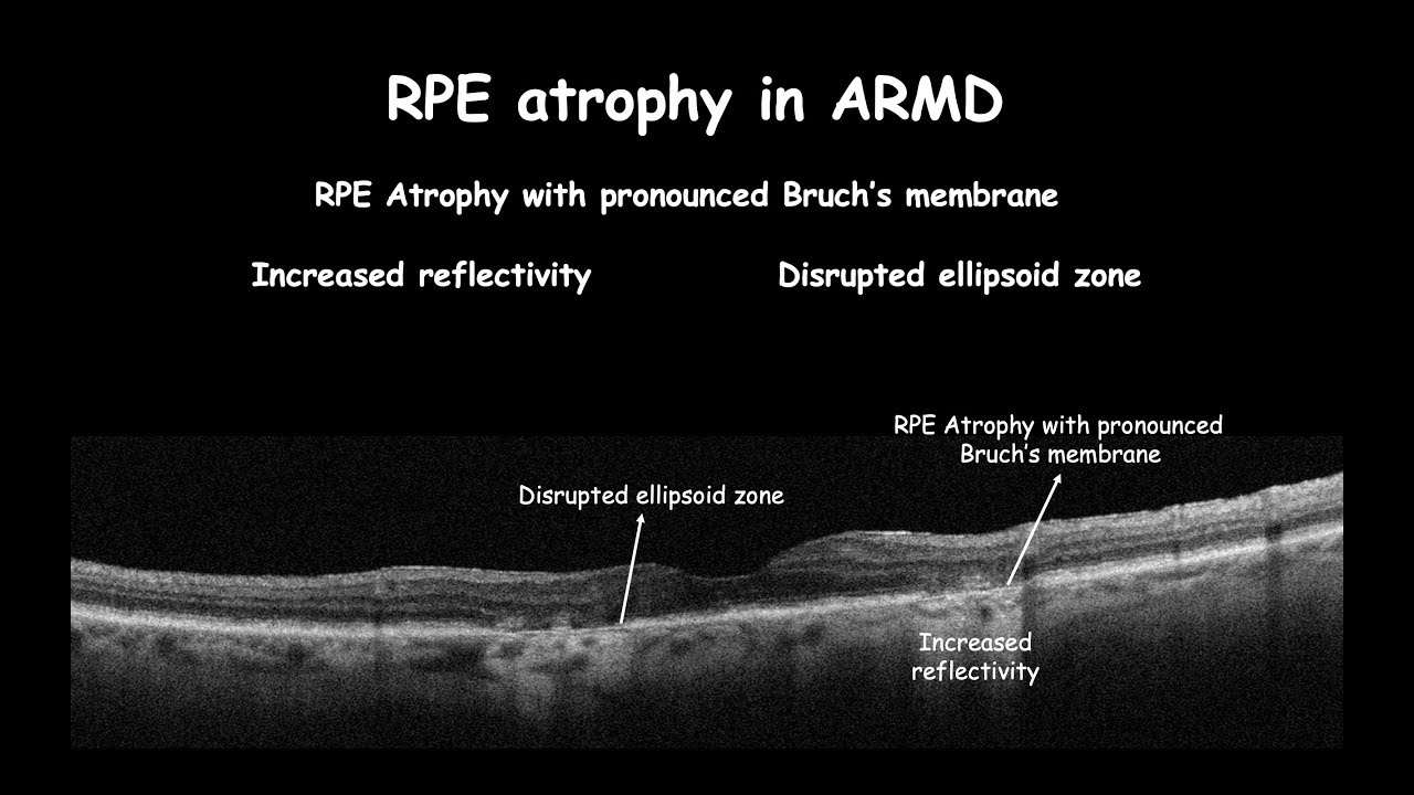 Clinical changes in RPE- RPE rip and Atrophy - YouTube