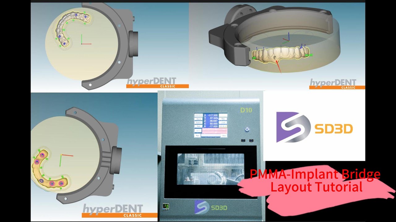 D10-Implant Half-tooth Bridge Layout Tutorial\pmma - YouTube