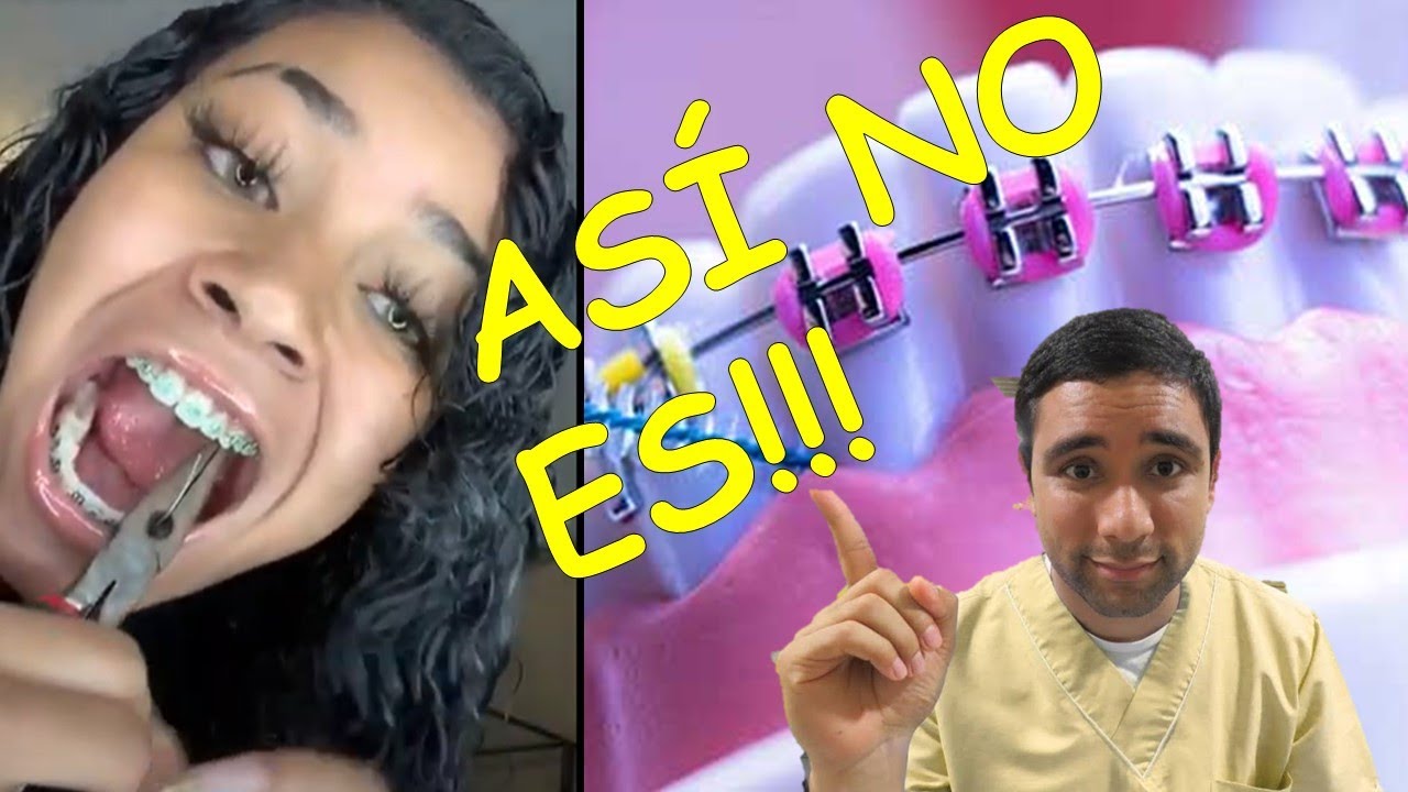 ¿Se te salió el alambre de los brackets? ¿Como se soluciona? 😎👀 - YouTube