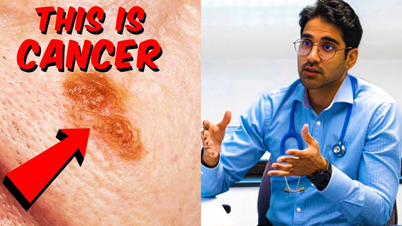 How to DETECT Melanoma SKIN CANCER Before It's TOO LATE - YouTube