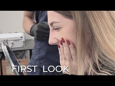 First look 10 days after Rhinoplasty | Dr. med. Simon Zimmermann - YouTube