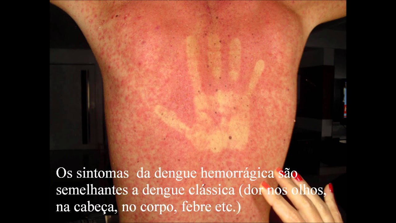 Dengue hemorrágica - YouTube