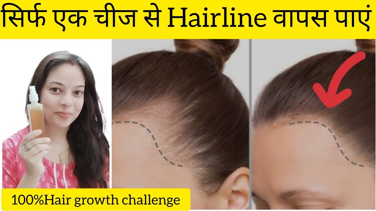 100%Grow receding hairline challenge Regrowth hairline, bald patches ...