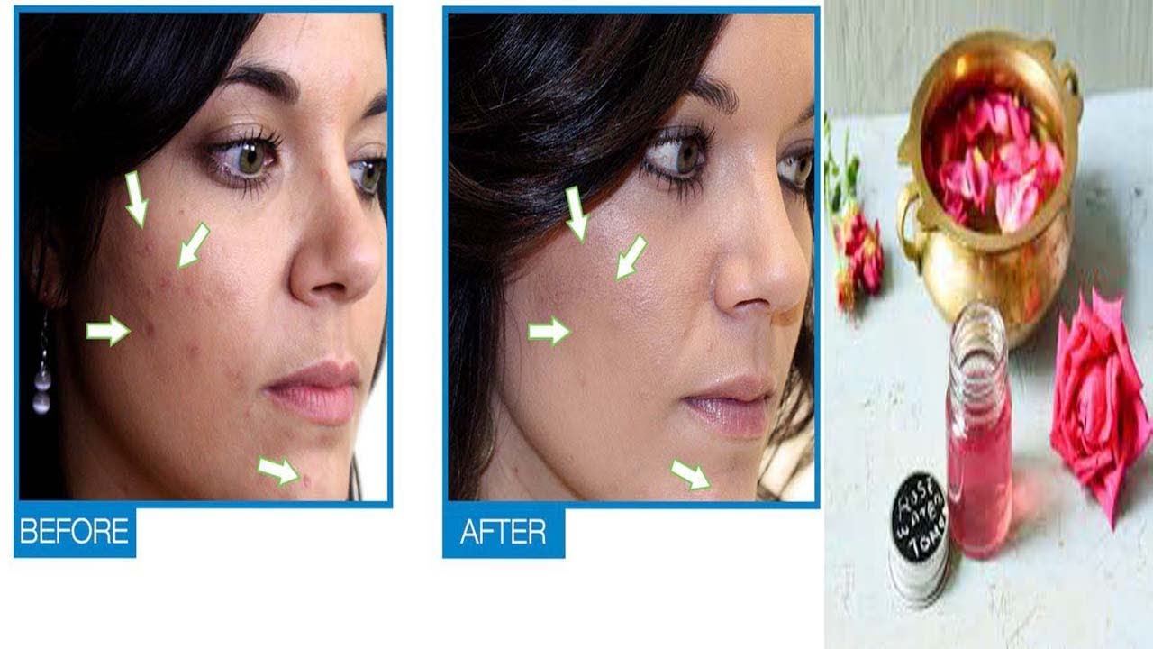 HOW TO REMOVE PIMPLES AND DARK SPOTS AT HOME HOMEMADE REMOVE PIMPLES AND GET GLOWING SKIN YouTube how-to-remove-pimples-and-dark-spots-at-home-homemade-remove-pimples-and-get-glowing-skin-youtube
