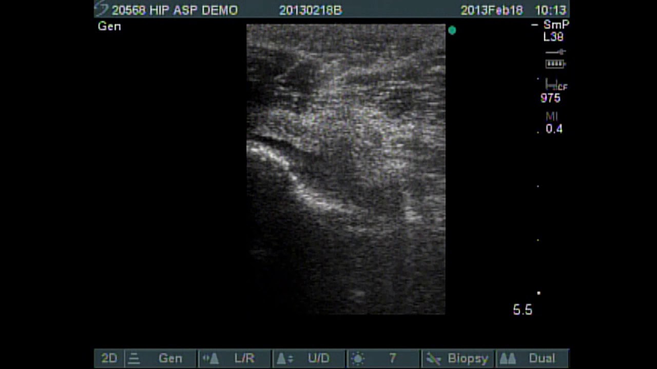 Ultrasound quided hip aspiration - YouTube