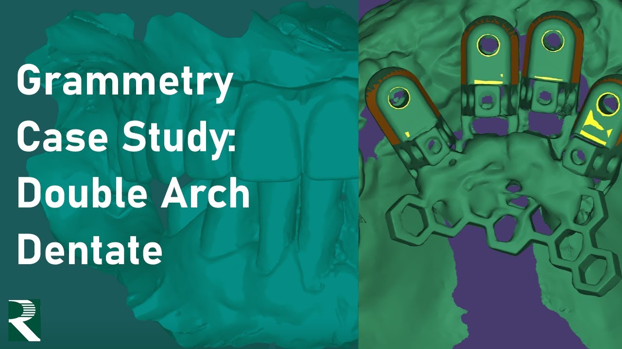 Grammetry Case Study: Double Arch Dentate - YouTube