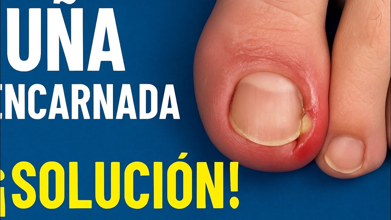 Matricectomia Fenol (Explicación ) #matricectomia #fenol #cirugía #uña ...