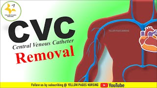 CVC Removal | Central Venous catheter removal steps |CV... | Doovi