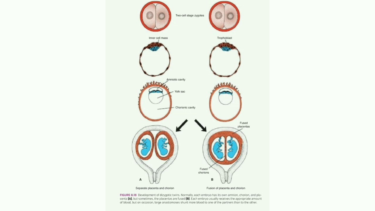 Twins, monozygotic twins vs dizygotic twins, clinical abnormalities ...