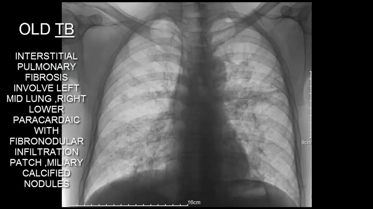 CASE 287 OLD TB ,IPF - YouTube