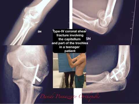 Coronal shear fracture in a teenager - YouTube