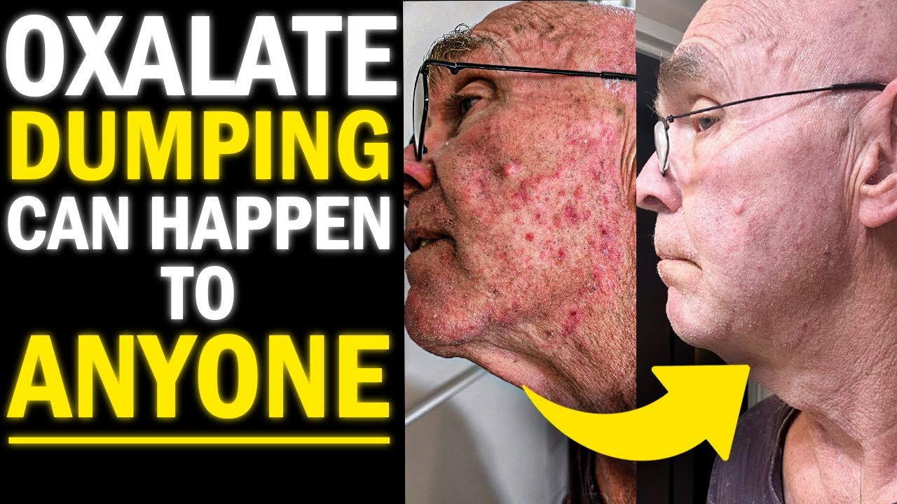 Your Standard Diet Is Causing You Oxalate Problems YouTube your-standard-diet-is-causing-you-oxalate-problems-youtube