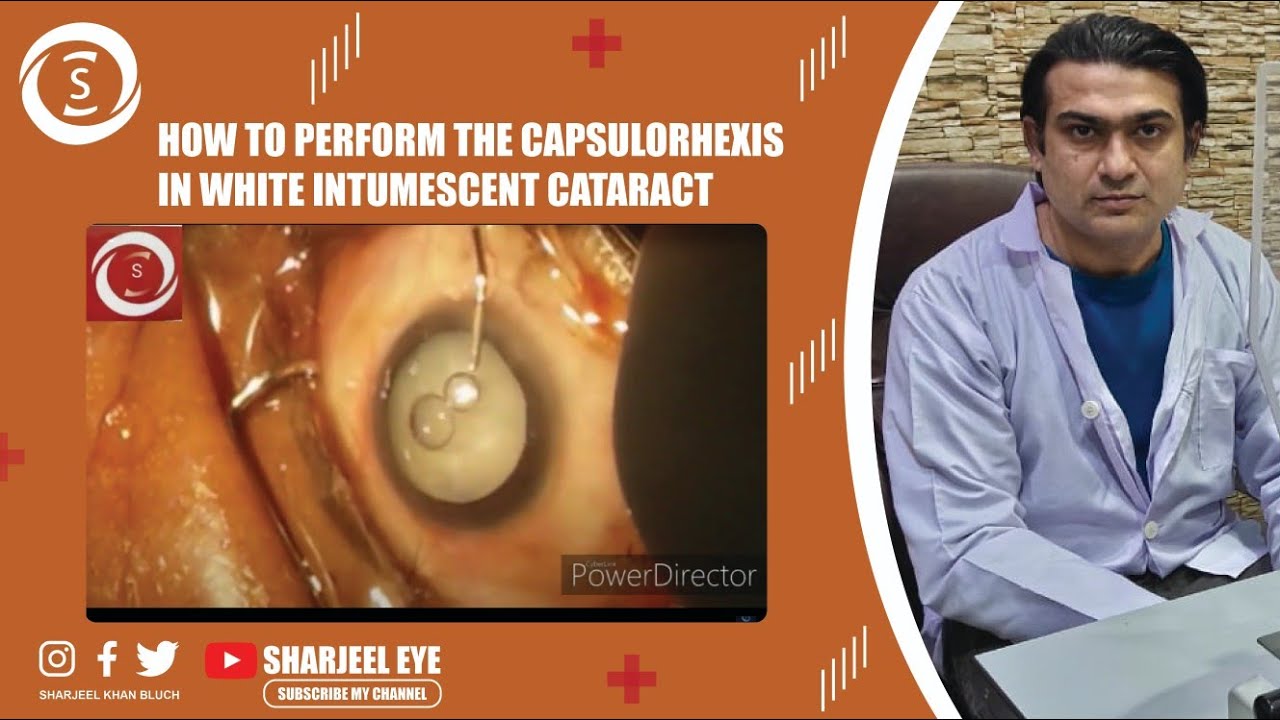 How to perform the capsulorhexis in white intumescent cataract - YouTube