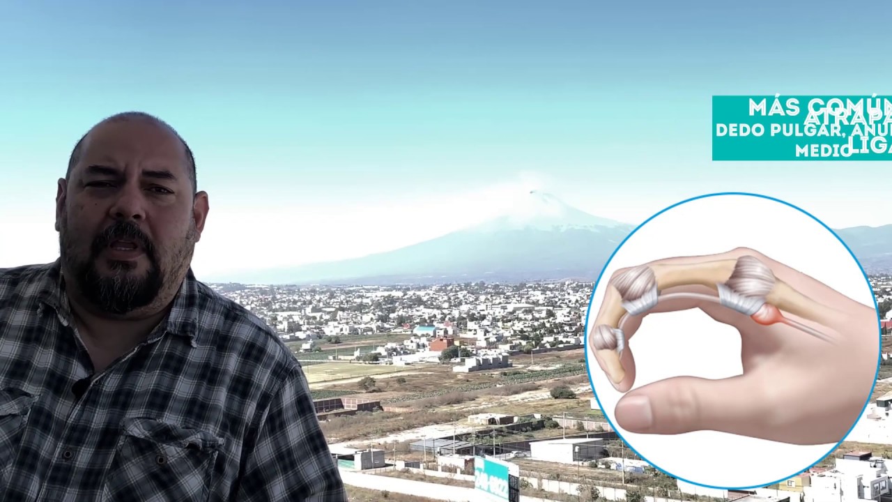 Síndrome dedo en gatillo o dedo resorte (tenosinovitis estenosante ...