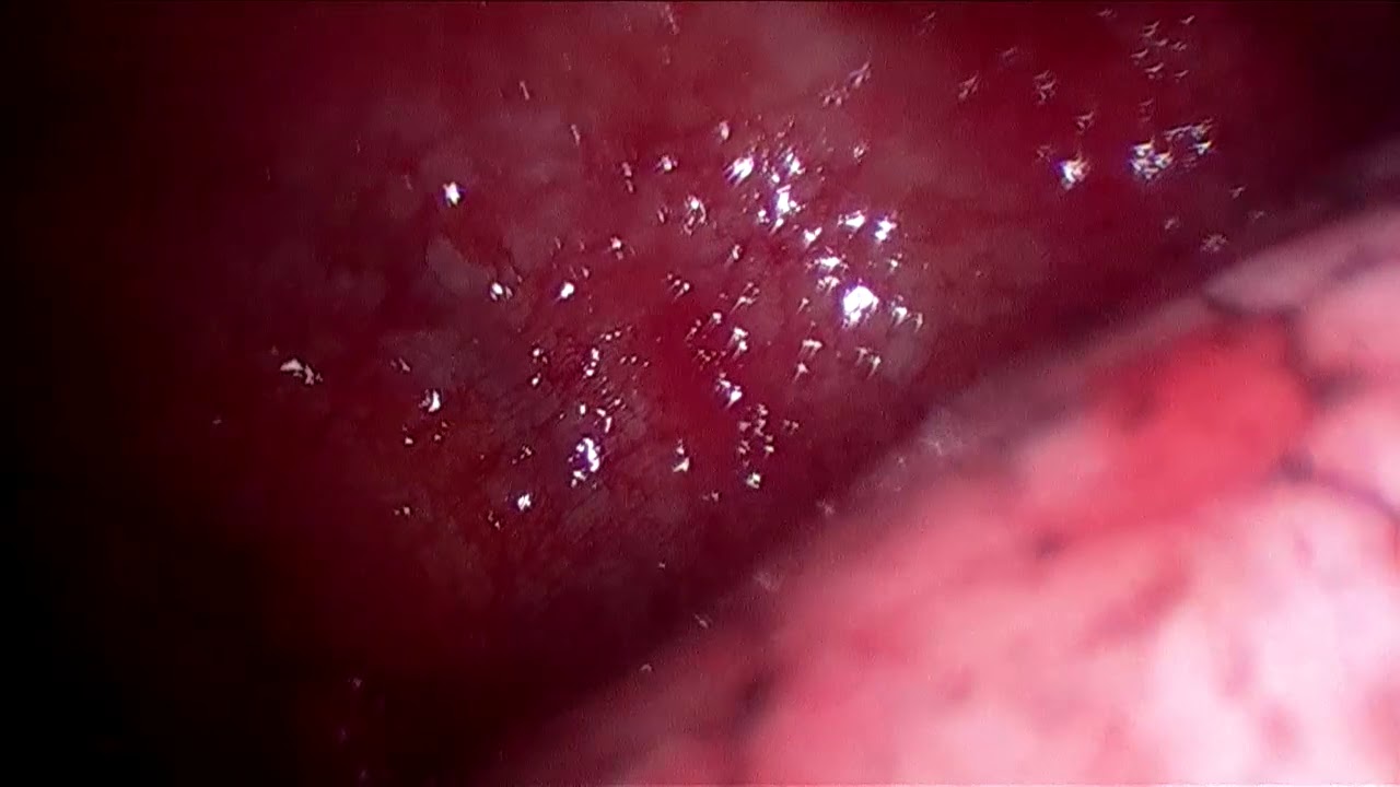 Pleuroscopia com biópsia e pleurodese com PVPI - YouTube