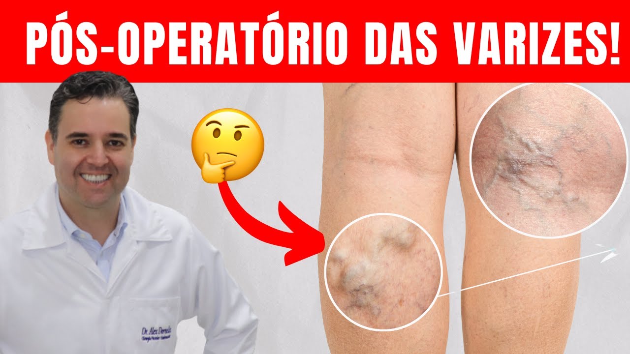 Pós-operatório do Tratamento de Varizes - Dr. Alex Vascular - YouTube