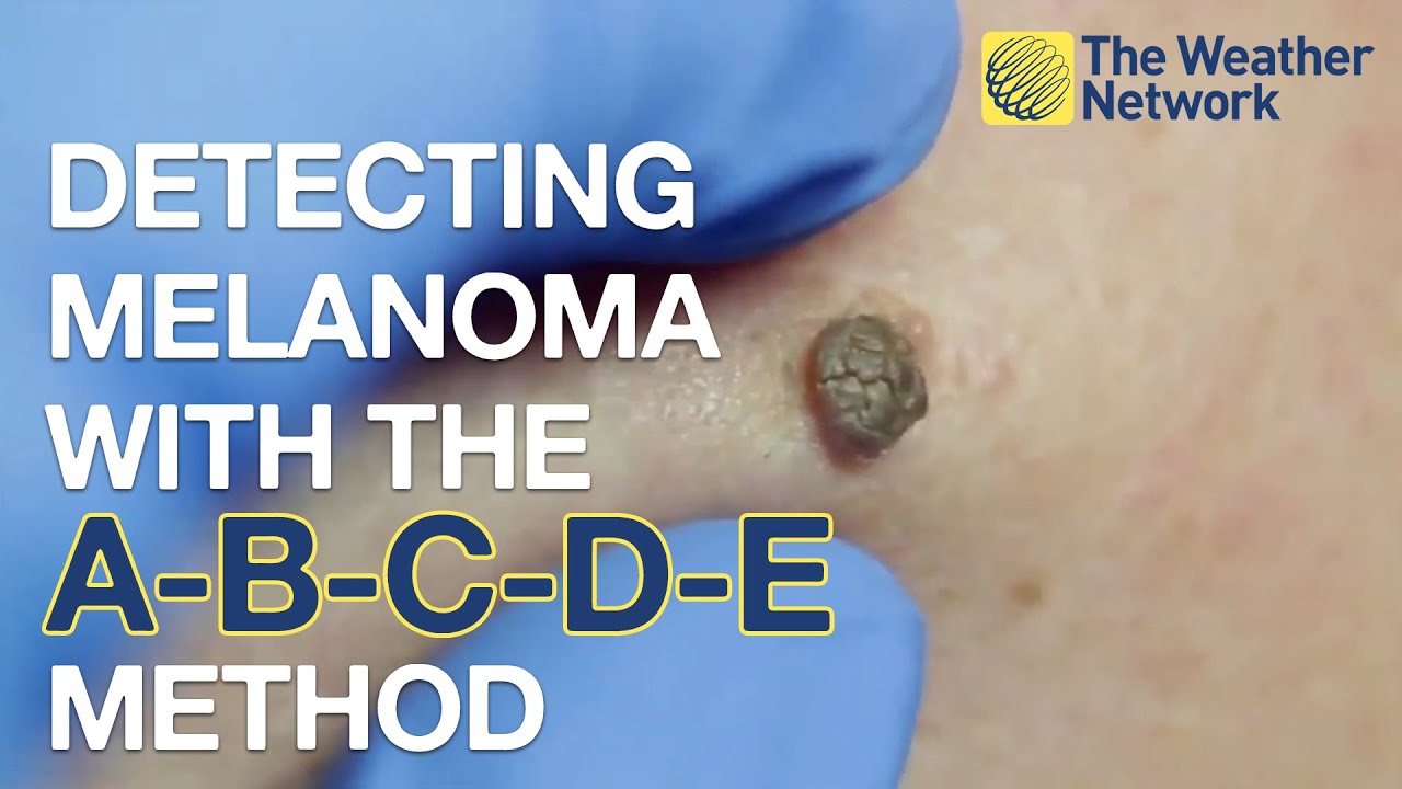 Detecting melanoma with the ABCDE method: Health and Weather - YouTube