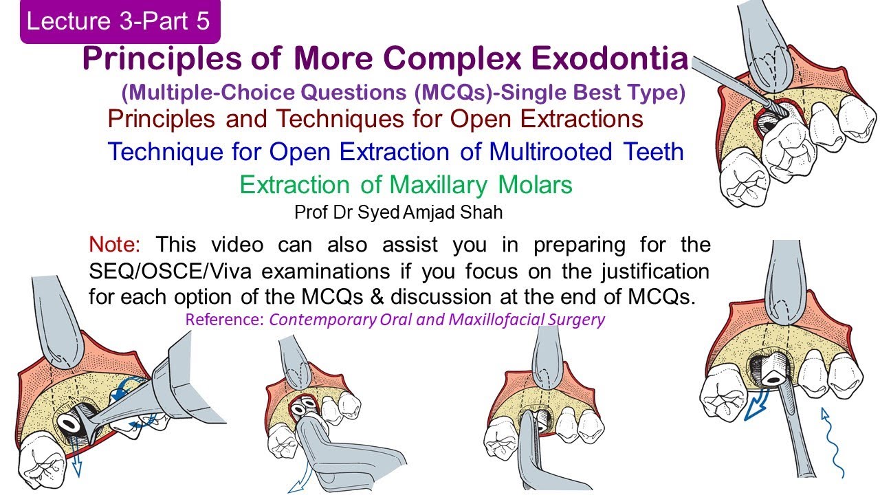 Lecture 3 Part-5 MCQs | Technique for Open Extraction of Multirooted ...
