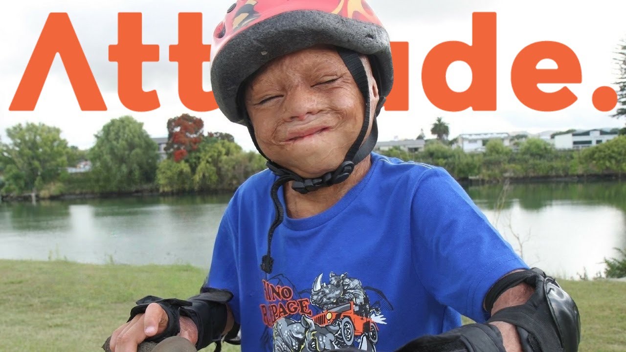 Burns Survivor: Dukie's Story - YouTube