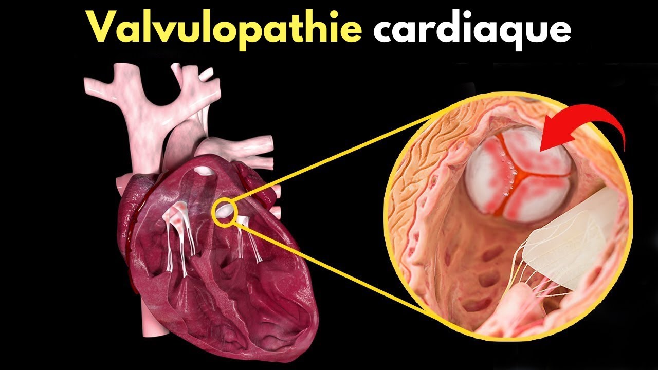 Comment se produit la valvulopathie cardiaque ? Symptômes, diagnostic ...
