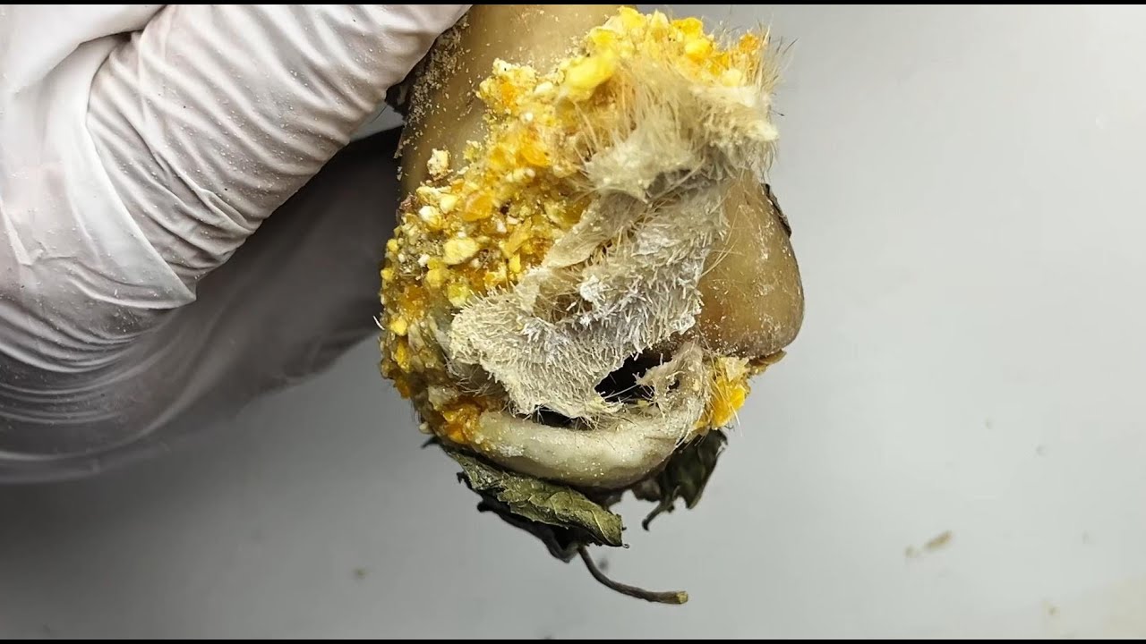 CUT Ingrown Toenails, Toenails with Maggots, Fungal Toenails ...