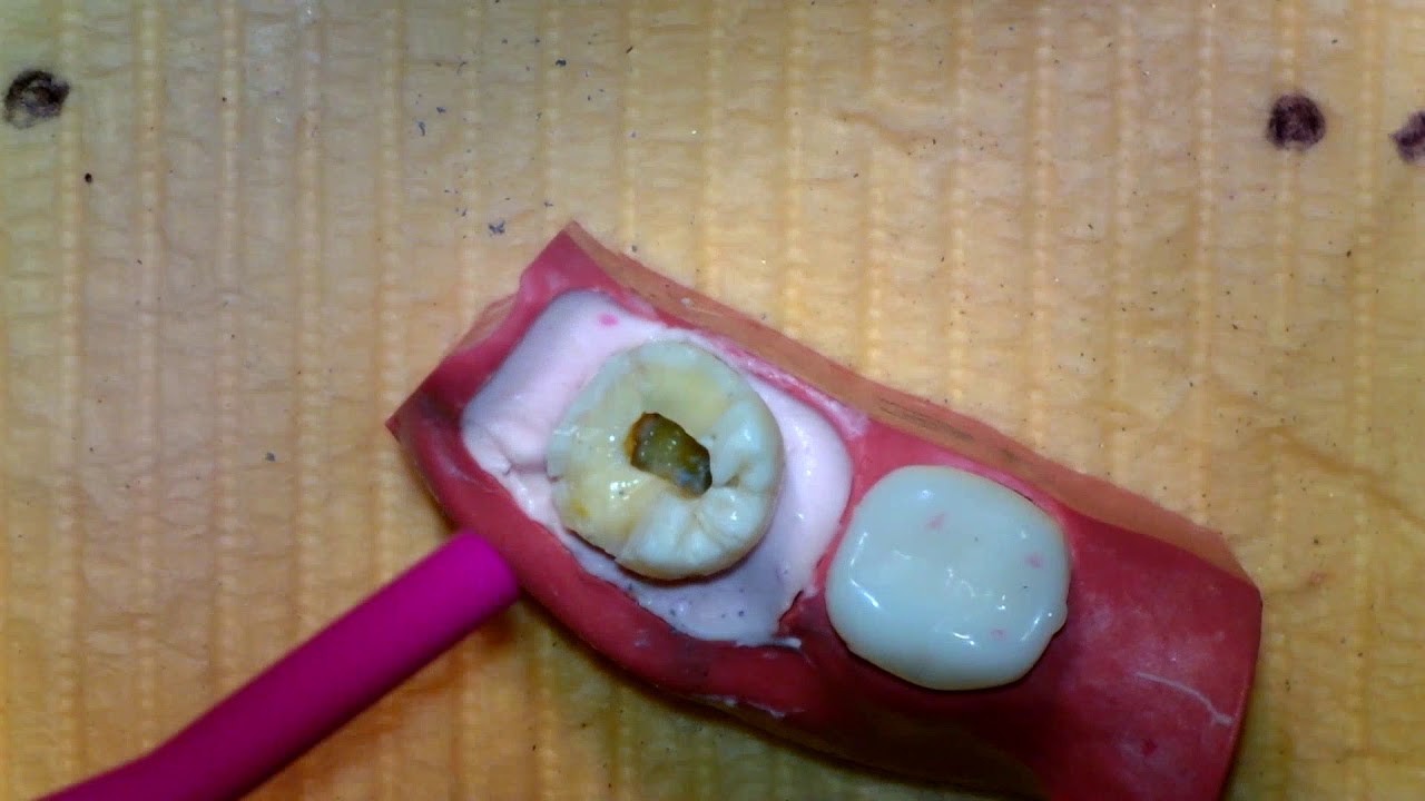 Posterior Prefabricated Post Placement - YouTube