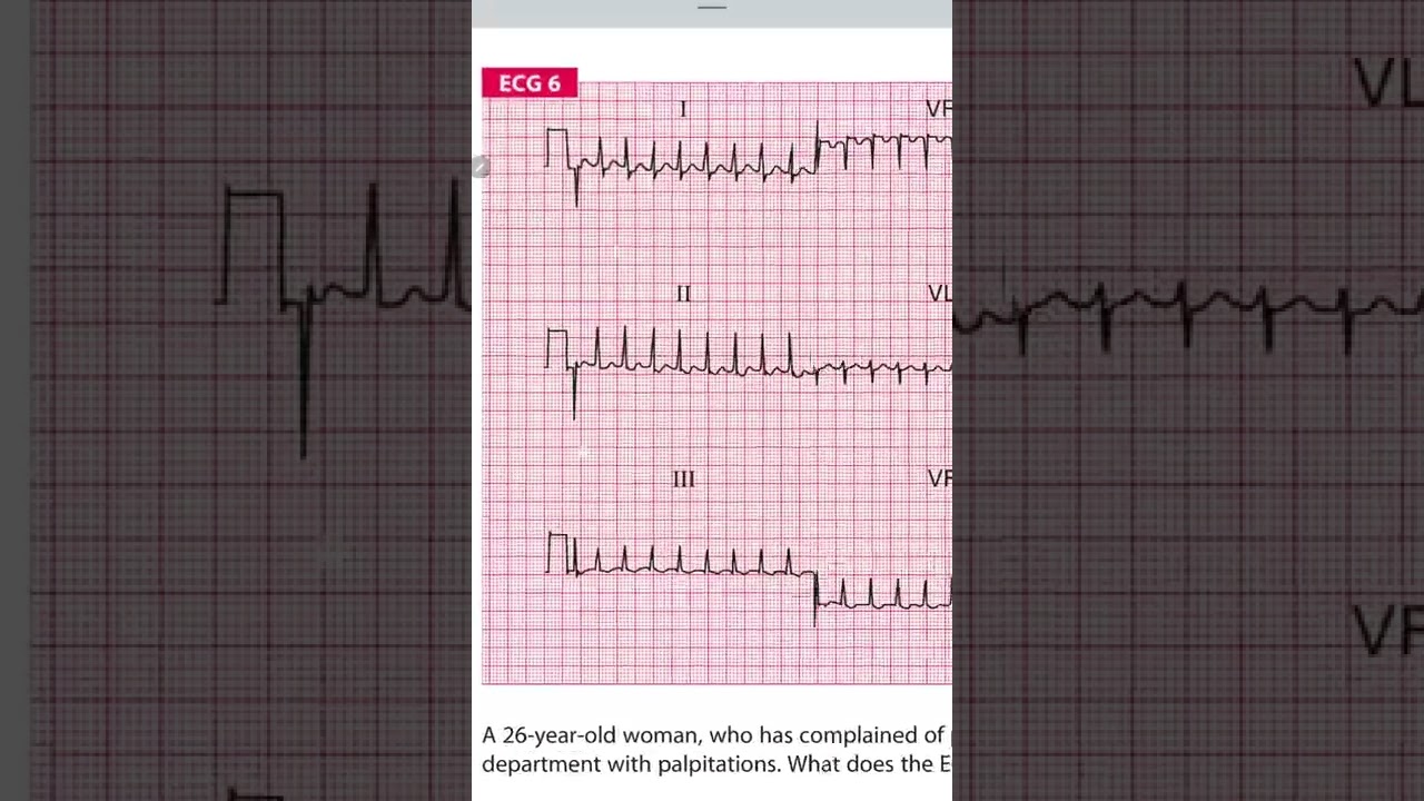 Clinical Exmples to read ECG |Learn ECG in one day part 9 | - YouTube