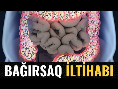 Baş bəlası BAĞIRSAQ İLTİHABI - Əsas səbəblər - Kron nədir?