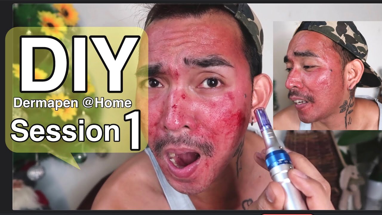 Deep Acne Scars Solution | DIY Microneedling Dermapen Session 1 @Home ...