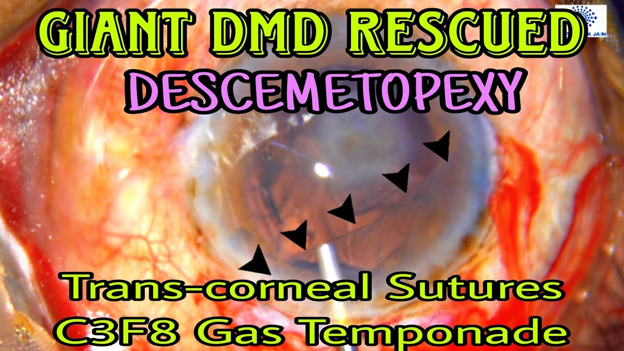 #148 Descemet Detachment |trans-corneal Suture, Air and C3F8 Gas ...