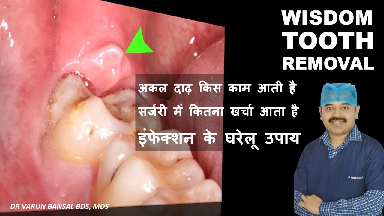 अकल दाढ़ के घरेलू उपाय। सर्जरी का खर्च। Wisdom tooth symptoms.दर्द ...