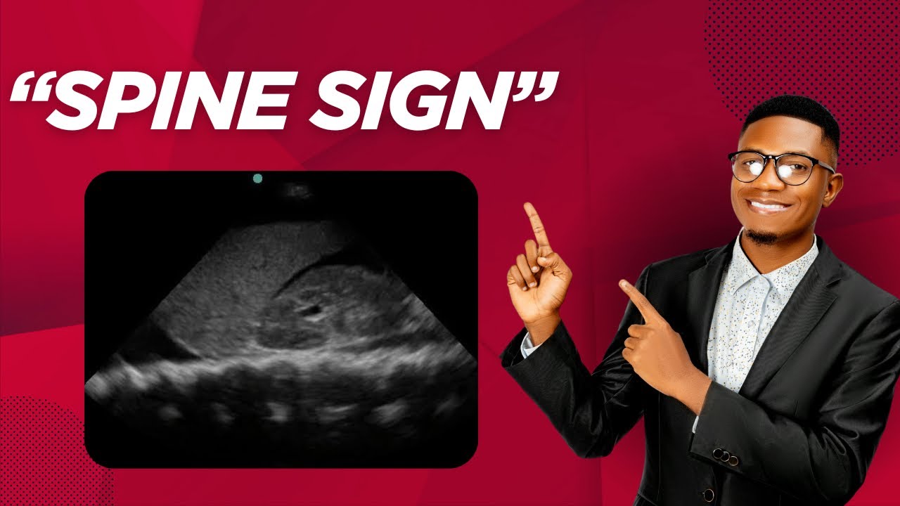 Spine Sign on Lung Ultrasound | POCUS for Pleural Effusion - YouTube