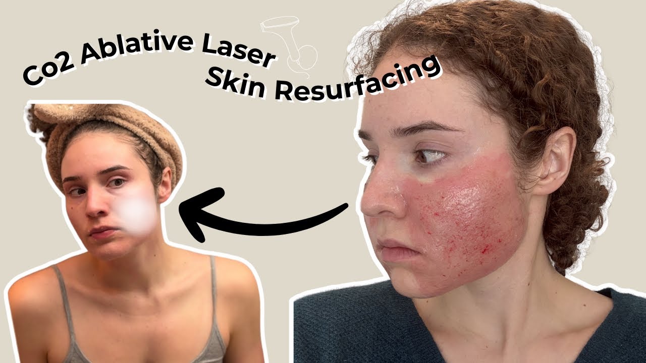 Heal with me | Co2 Ablative Resurfacing Laser Experience ️‍🩹 - YouTube