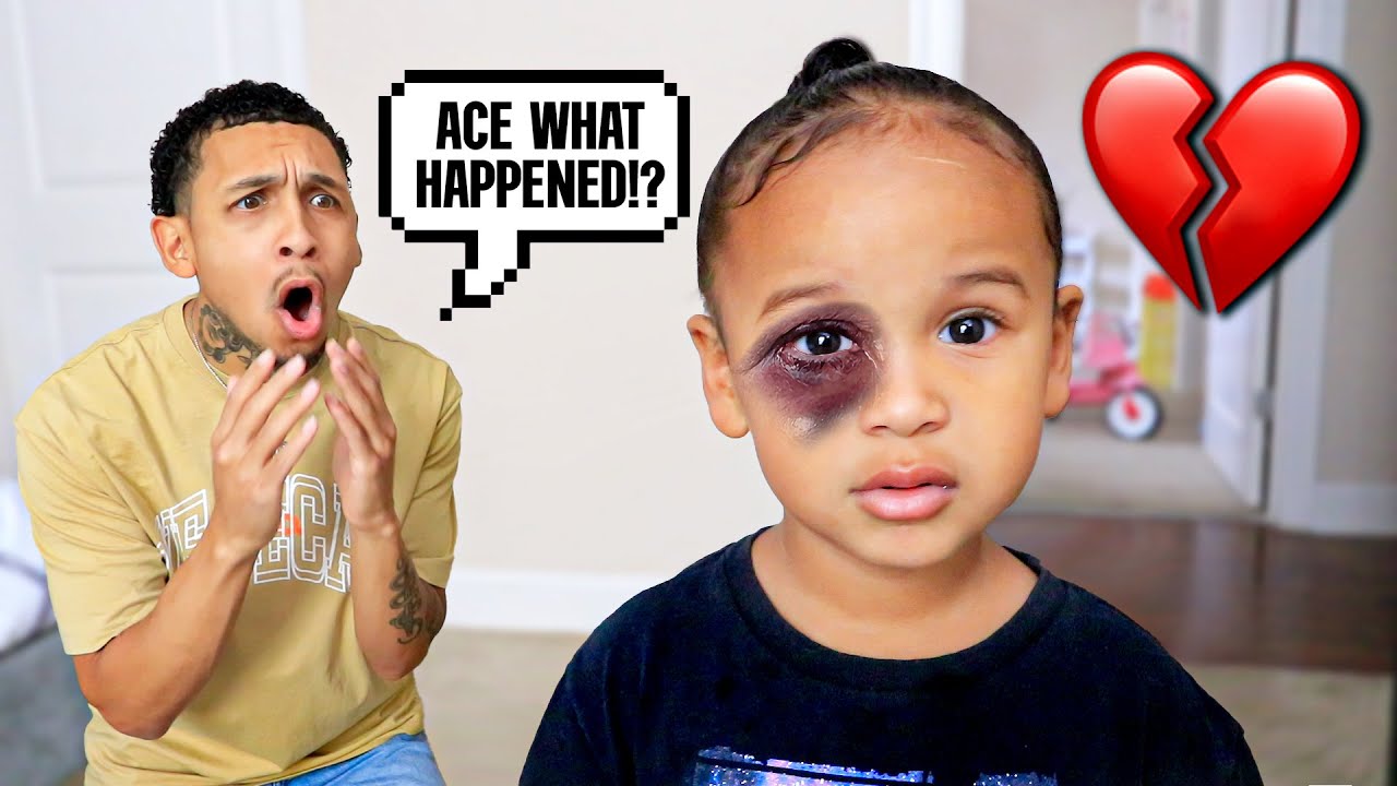 BLACK EYE PRANK ON DAD! - YouTube