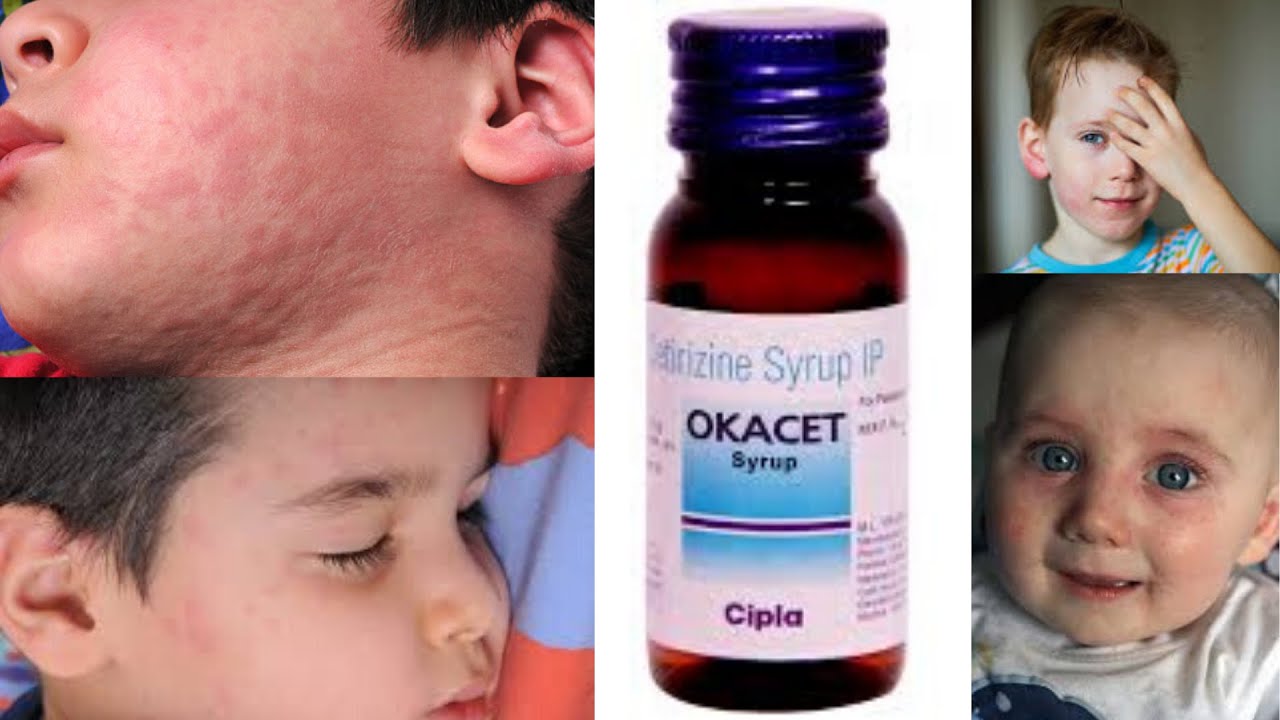 Cetirizine Syrup | Okacet Syrup To Relieve Itching , Redness , Hives ...