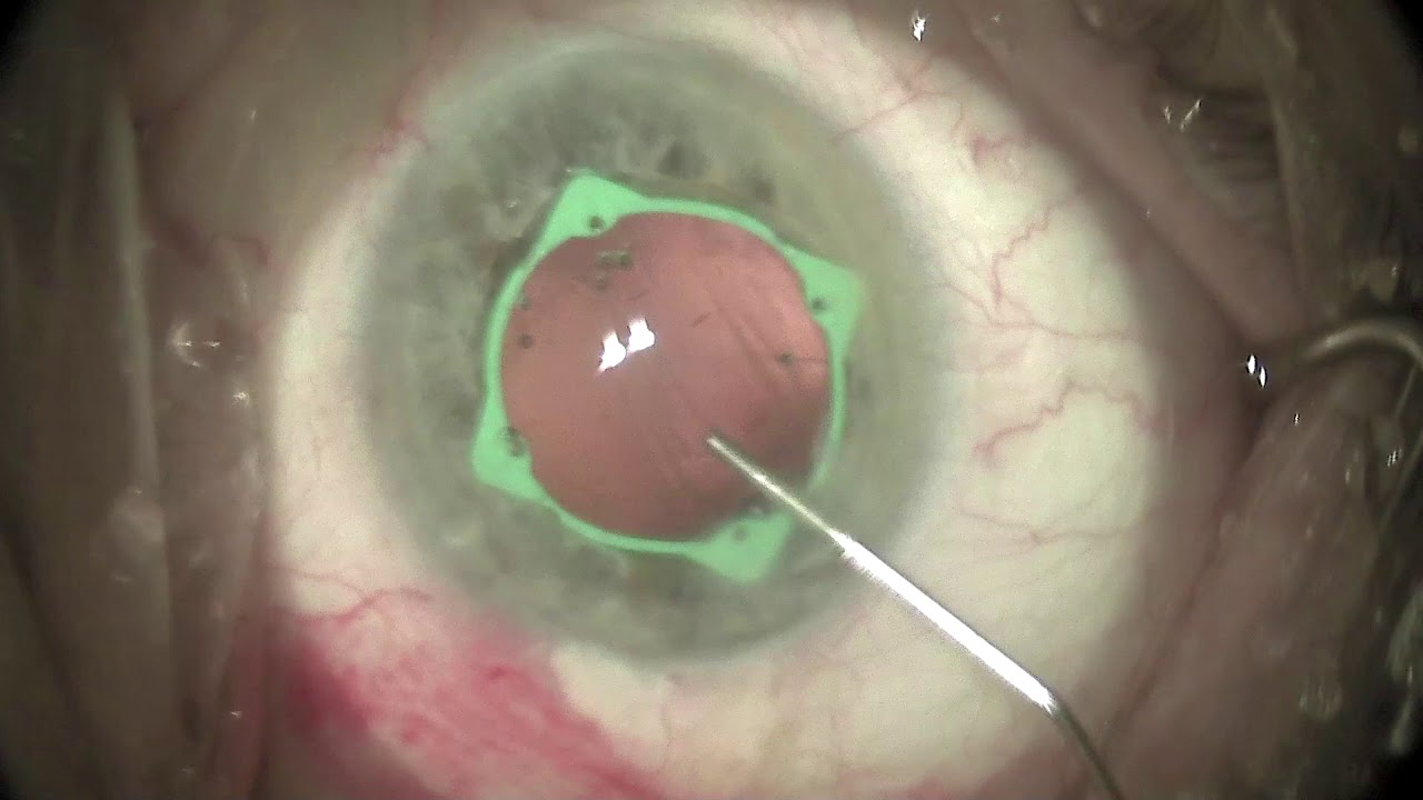 Phaco using I-Ring pupil expander: first test - Sandro Scrittori MD ...
