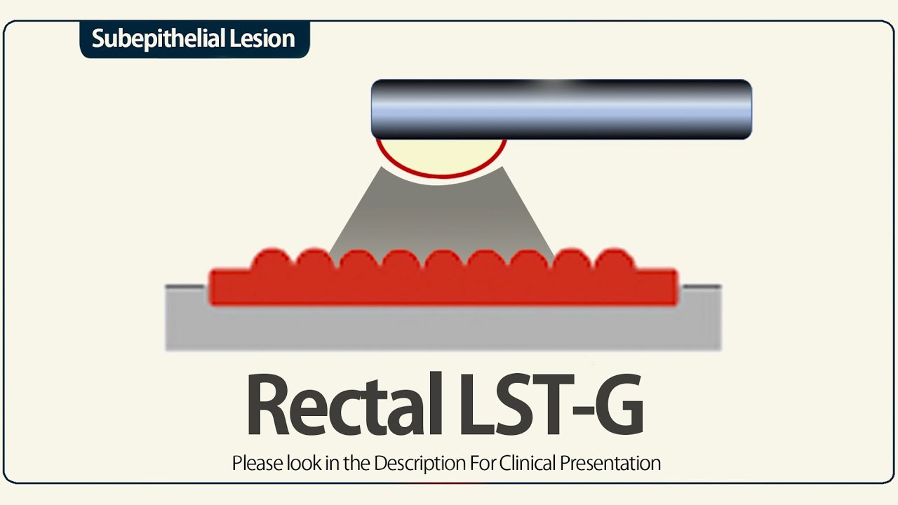 Linear EUS: Rectal LST-G - YouTube