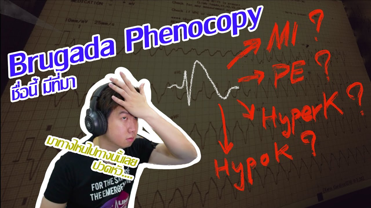 เมื่อสิ่งที่เห็น อาจจะไม่ใช่สิ่งที่คิด... Brugada phenocopy | EKG ...