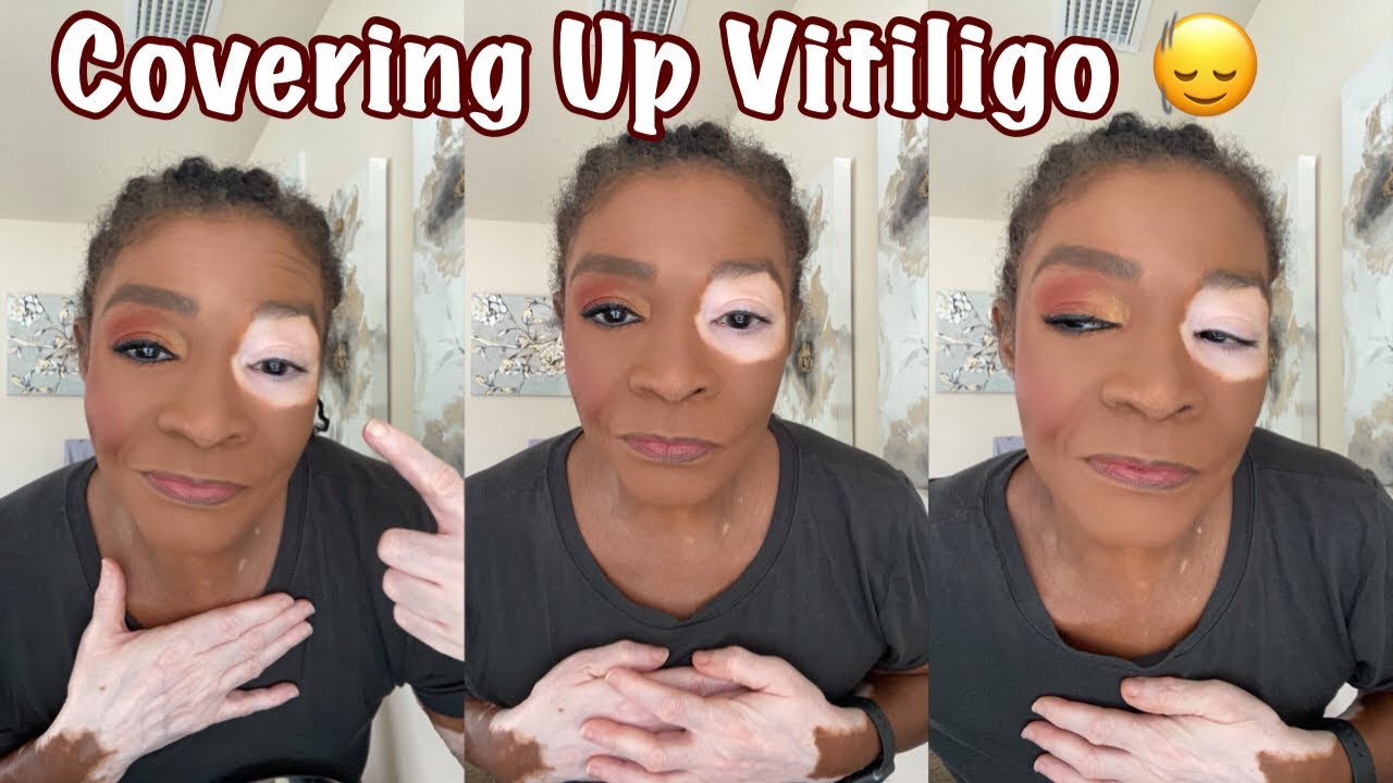 Covering Vitiligo: My Step-by-Step Eyeshadow Routine | Living with ...