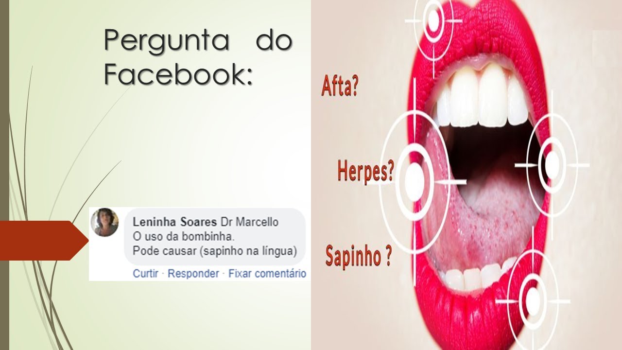 Sapinho | O uso da bombinha pode causar Candidíase Oral na língua? | Dr ...
