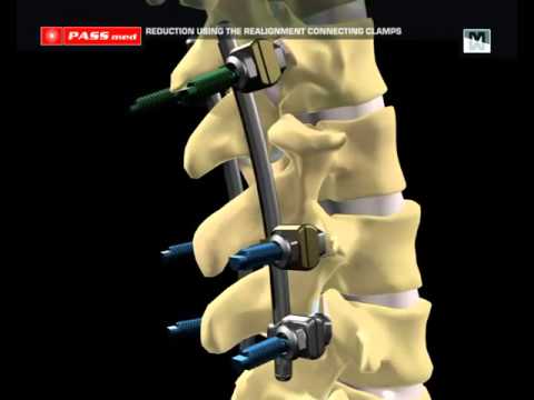 Ortocir Ortopedia Pass Med Medicrea Connecting Clamps - YouTube