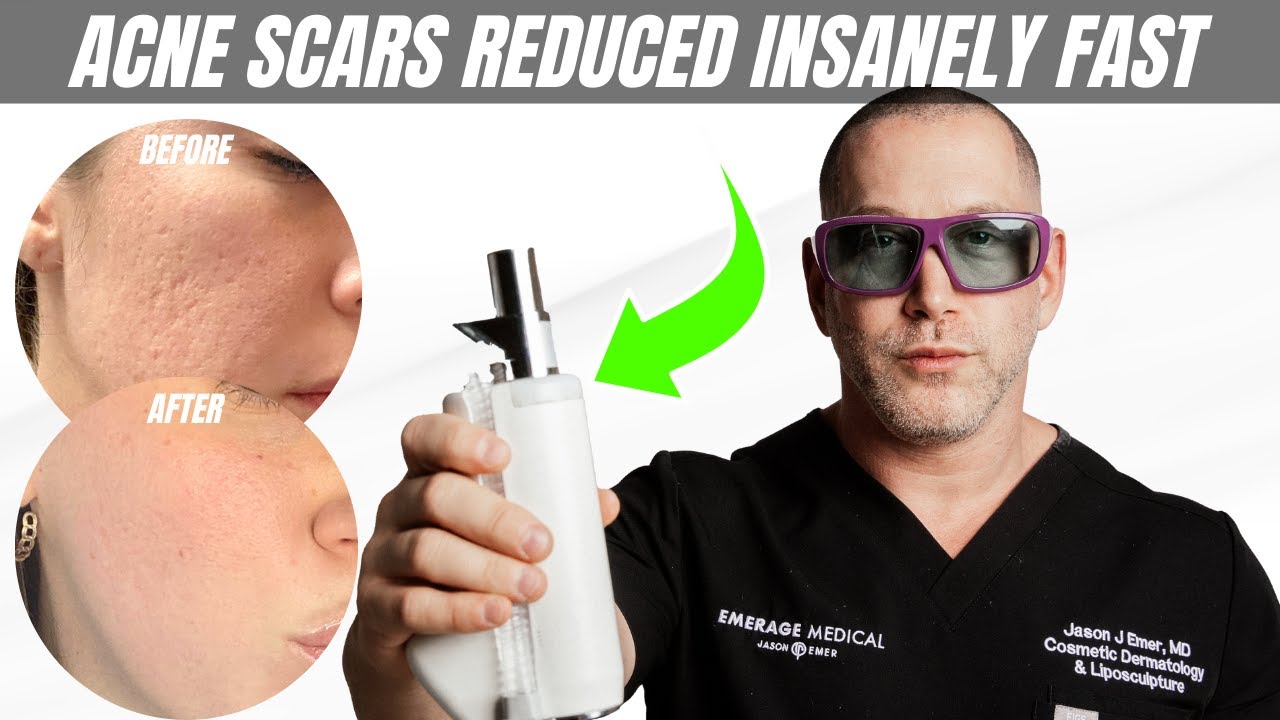 BYE-BYE Acne Scars: Reducing Acne Scars with LASERS | Dr. Jason Emer ...
