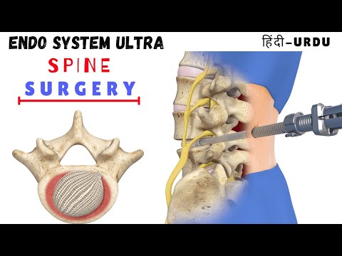 ENDO SYSTEM ULTRA: "The Minimally Invasive SPINE SURGERY Solution"# ...