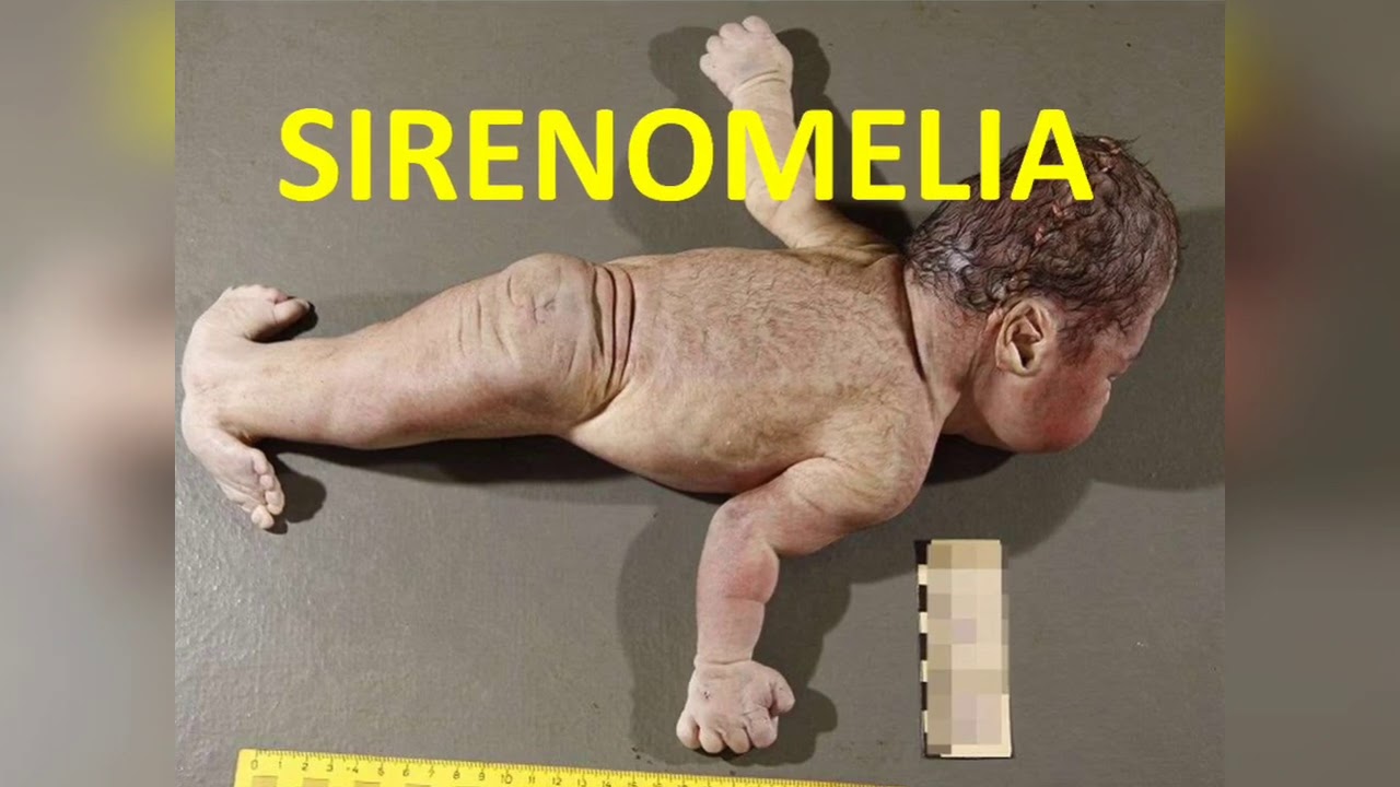 #Sirenomelia# - YouTube
