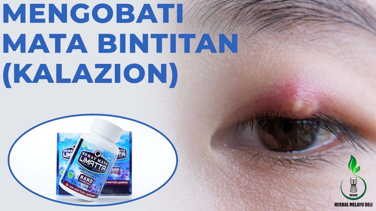 Menyembuhkan Penyakit Mata Kalazion (Benjolan Pada Kelopak Mata ...
