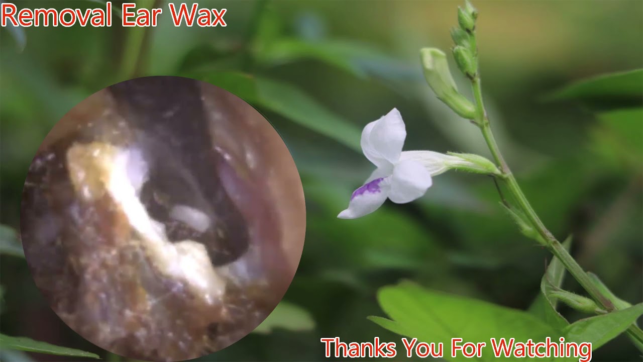 Removal Ear Wax Explode after Blocked - YouTube